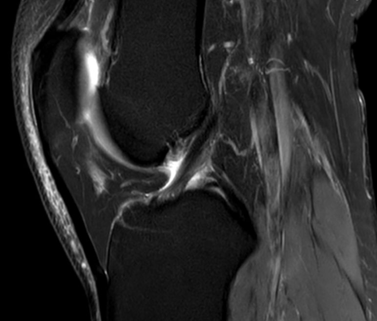 intact ACL MRI – ד"ר איתמר בוצר